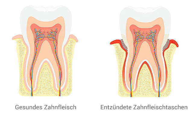 PerioChip Behandlung bei chronischer Paradontitis – Ihr Zahnarzt in Basel